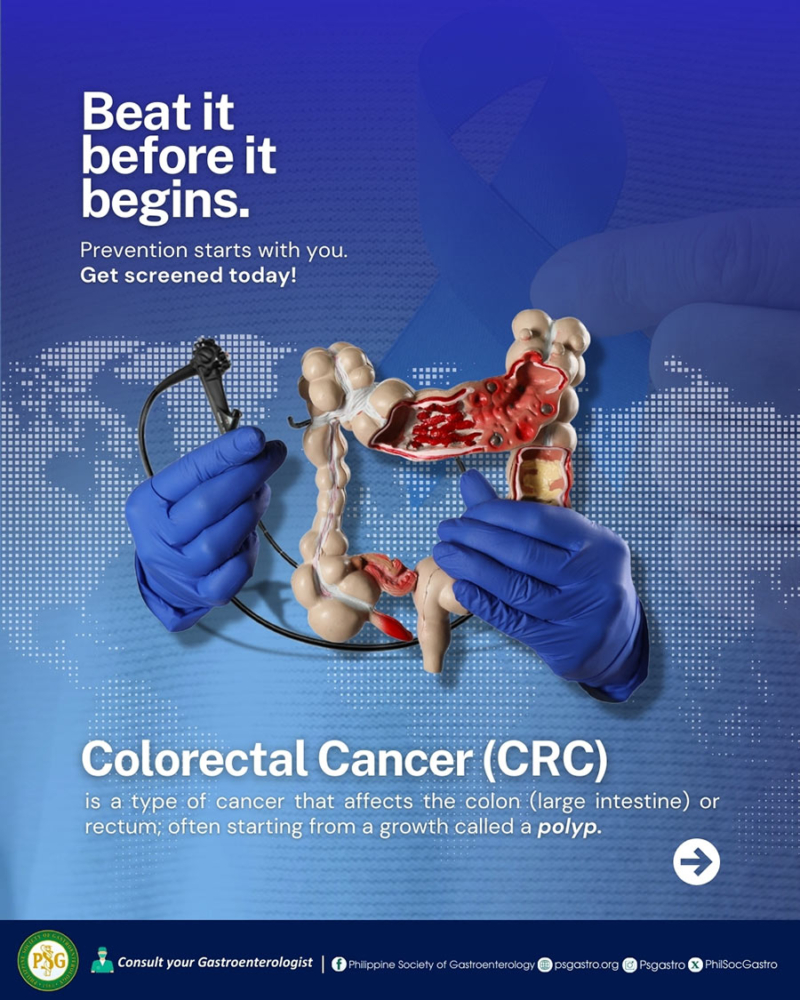 Colorectal Cancer (CRC) - Philippines Society of Gastroenterology